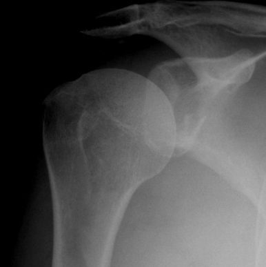 Acute Anterior Dislocation | The Bone School